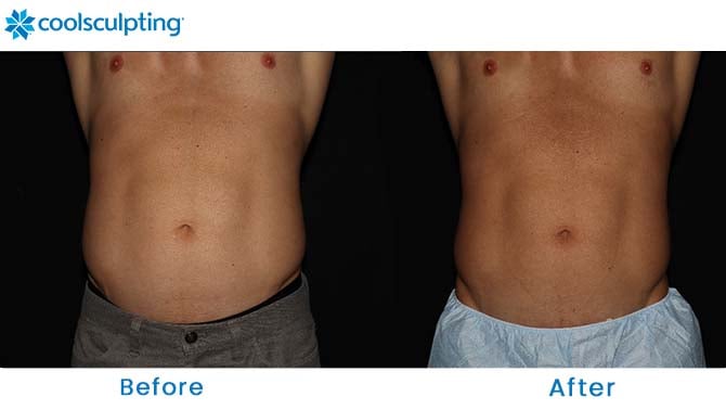 Coolsculpting Before And After Pictures Male Stomach